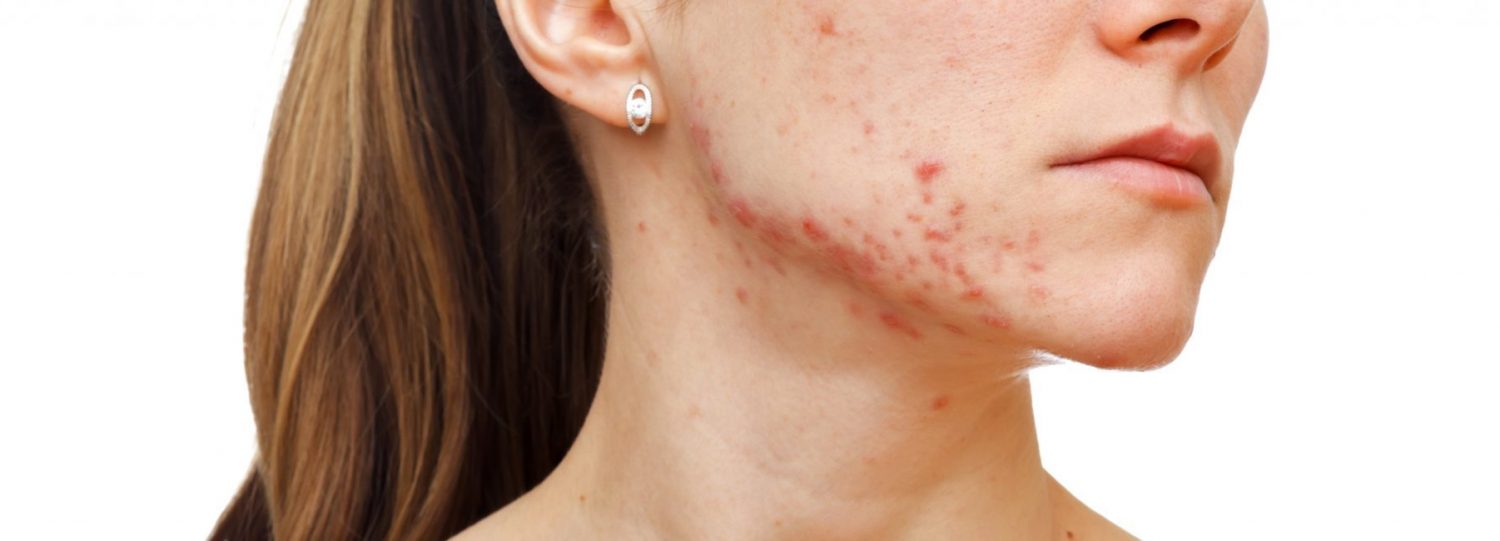 ACNE-Q | Q-Portfolio - MEASURING WHAT MATTERS TO PATIENTS